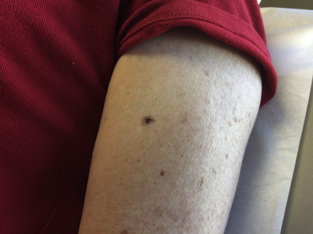 Black Spot Poison Ivy. WHAT!? – Messymom